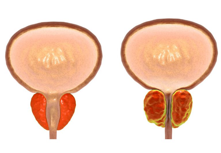 Benign Prostatic Hyperplasia (BPH) - Urologist | Dr. Akhil K. Das ﻿| BPH & Lower Urinary Tract ...